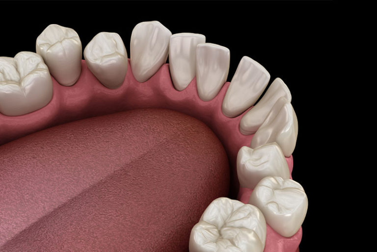 Crooked Teeth | Roslyn | Bethpage, NY | Gitlin Dental Group